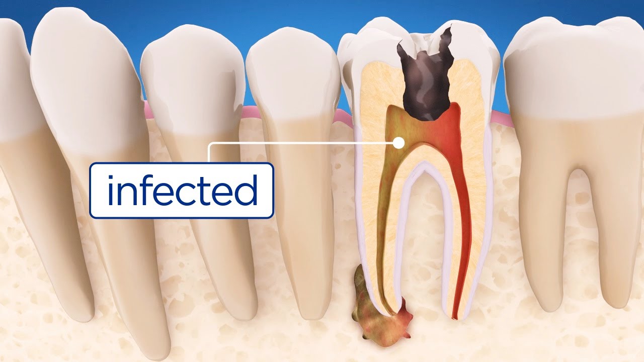 The Top 17 Pros and Cons of a Root Canal Treatment